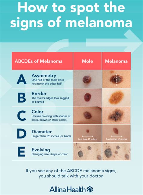 Abcde Signs Of Melanoma Seniors Blue Book