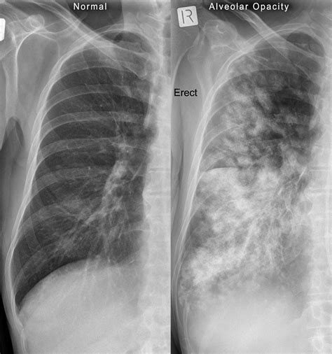 Lung Density On X Ray