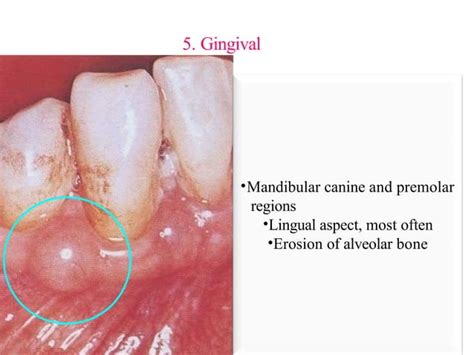 Types And Classification Of Gingival Enlargement Pptx
