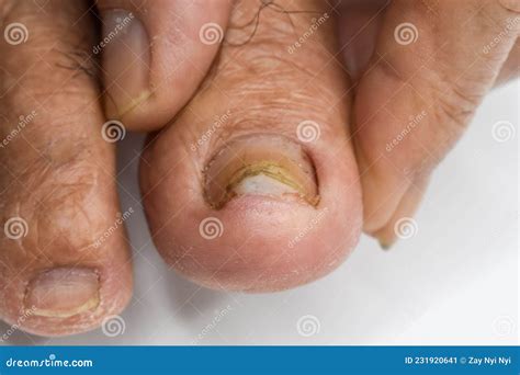 Fungal Nail Infection Onychomycosis Also Called Tinea Unguium Stock
