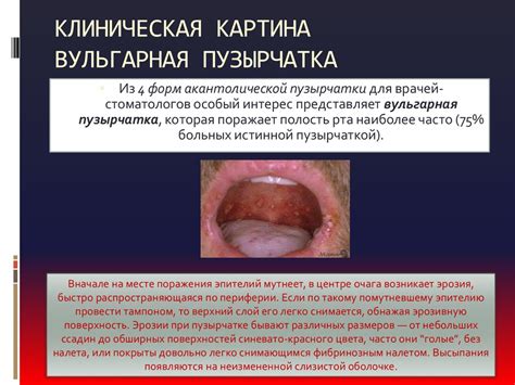 Пузырчатка Этиология Патогенез Клиническая картина Гистопатология