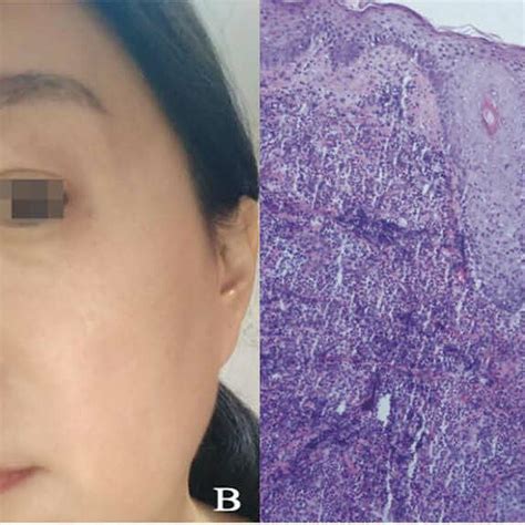 Sweet Syndrome Manifestation A Edematous Erythema On The Left Lower Download Scientific