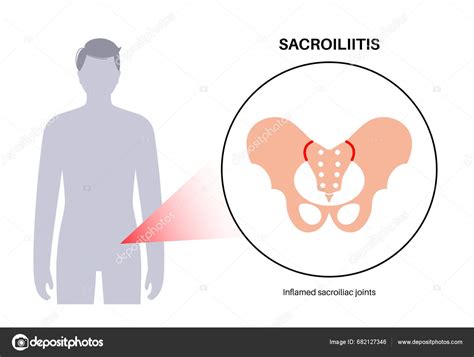 Sacroiliitis Disease Concept Inflamed Sacroiliac Joints Lower Spine Pelvis Inflammatory Stock
