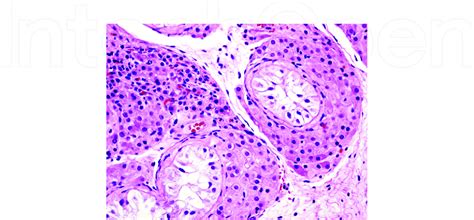 Male Pseudohermaphroditism Patient With Dysgenetic Testes Note The