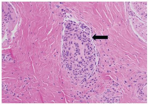 Painful Feet As The Presenting Symptom Of Mononeuritis Multiplex In A