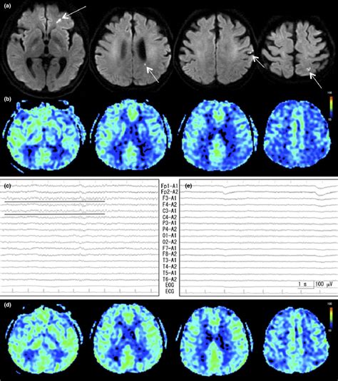 Case 4 A Diffusion Weighted Images Showed Multiple Embolic Download Scientific Diagram
