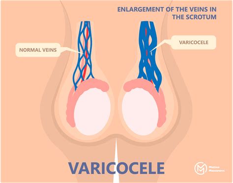 Varicocele Ligation What Is It And Its 3 Types And The Recovery Time