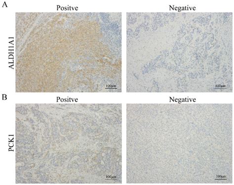 Pck1 And Aldh1a1 Are Identified As Biomarkers For Inherent Drug Resistance In Hepatocellular