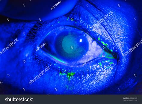 Punctate Epithelial Erosions