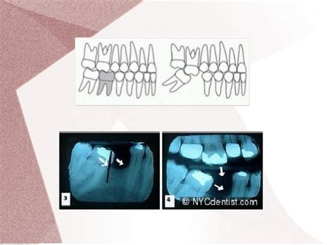 Extraction Of The First Permanent Molar Ppt