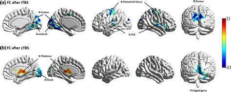 Functional Connectivity After Itbs And Ctbs On Right Precuneus B Download Scientific Diagram