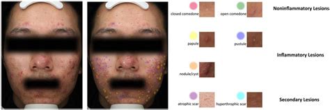 An Example Of Seven Types Of Acne Related Lesions Identified By The