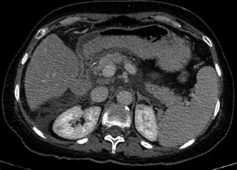 Laparoscopic Gastrojejunostomy For The Treatment Of Sirt Induced Duodenal Ulcer Complicated By