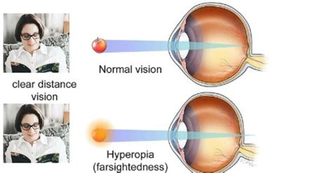 Understanding Hyperopia Causes Symptoms And Treatment Options For