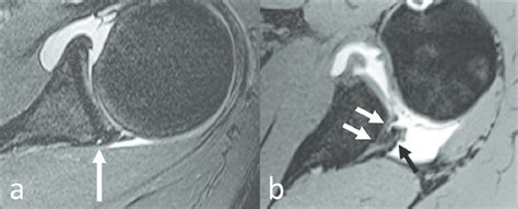 Mr Arthrogram Of 34 Year Old Male With History Of Chronic Posterior Download Scientific Diagram