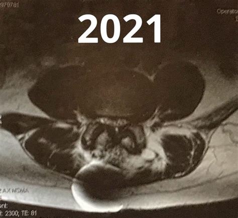 My 20 Year Old T4 L5 Spinal Fusion Surgery Is Failing I Have Been