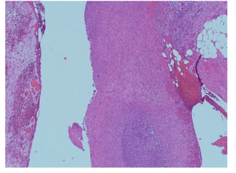 Diverticulitis And Diverticulosis Of The Appendix A Case Series Abstract Europe Pmc