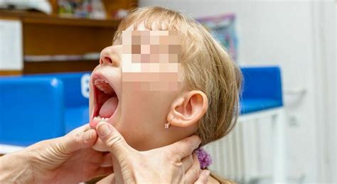 Streptococco Sintomi Tamponi E Terapia Con Antibiotici Cosa Fare