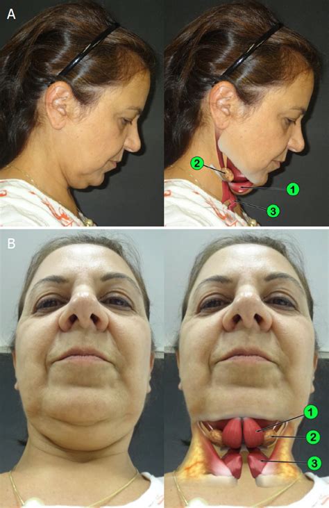 Sternocleidomastoid Muscle Swelling