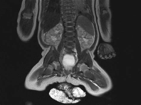 Caudal Appendage Human