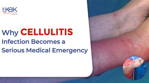 How Dangerous Is Cellulitis Infection Risks Explained