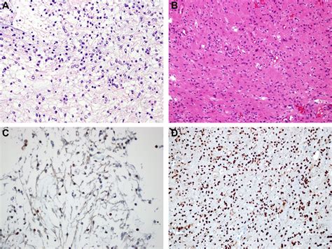 Impact Of H3 3 K27m Mutation On Prognosis And Survival Of Gr Neurosurgery