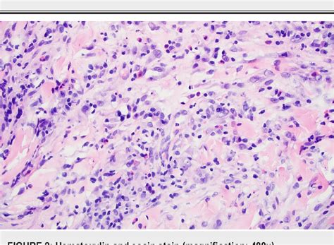 [pdf] Arthropod Bite Mastitis As A Mimicker Of Breast Cancer Semantic Scholar
