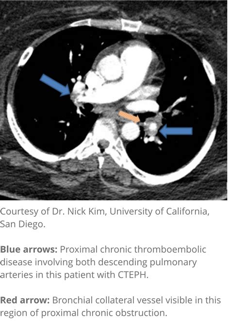 Cteph Assessing Patients For Pulmonary Thromboendarterectomy In Cteph