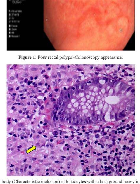 Figure 2 From Rectal Malakoplakia Presenting As Multiple Rectal Polyps