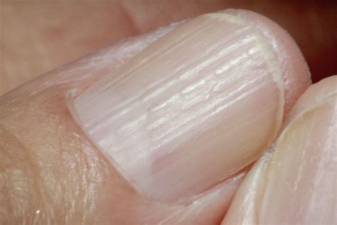 Enfermedades De Las Uñas Causas Tipos Y Diagnóstico Sexiezpix Web Porn