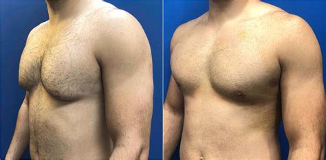 Male Breast Reduction Case 25