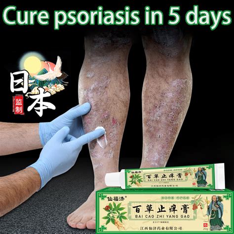 Psoriasis Cream Dermatitis Eczematoid Eczema Ointment 20g Krim Rawatan