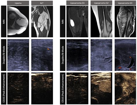 Liposarcoma