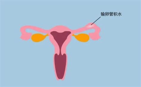 出现输卵管积水会有哪些症状？ 知乎