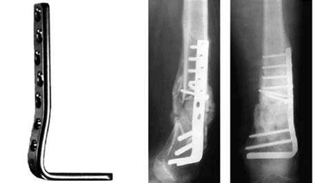 Distal Femur Fracture Ppt