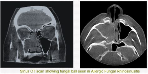 Allergic Fungal Diseases Allergy Asthma Sinus Doctor In Houston