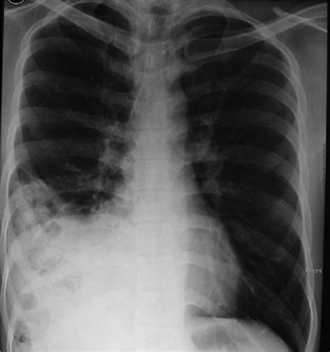 Simple Chest X Ray Showing A Non Specific Opacity At The Right Lower