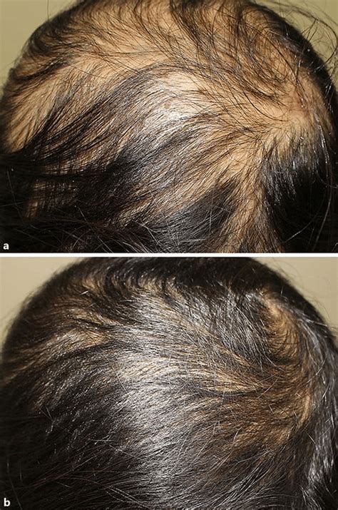 A Significant Improvement In Terms Of Decreased Scalp Inflammation And