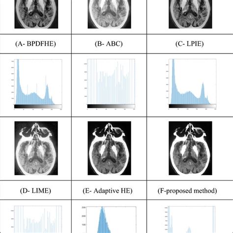 New Improved Optimized Method For Medical Image Enhancement Based On