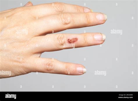 Female Hand With A Scab Due To Impetigo A Contagious Bacterial
