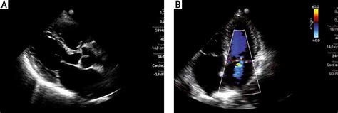 Feasibility And Clinical Utility Of Real Time Tele Echocardiography