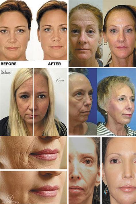 Cheek Filler Cheek Injections Beautox Bar