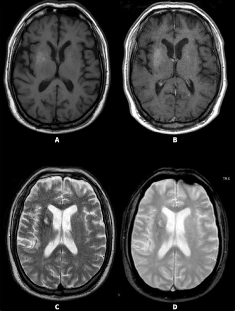 Case 2 Initial Mri Brain Images Showing T1 Hyperintensity In The