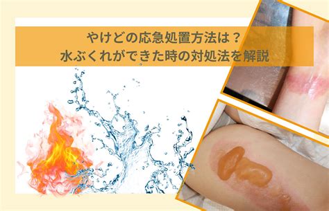 やけどをしてしまうと、どうしたらよいのかと焦ってしまいますよね。場合によっては、水ぶくれができてしまったりします。