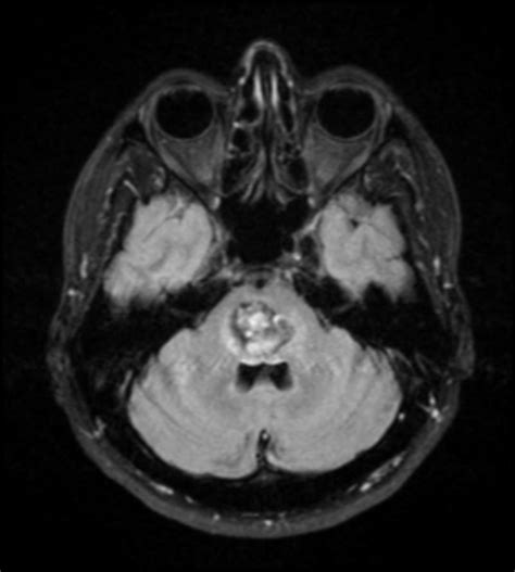 Cavernous Angioma Neurosurgery Ucla Health