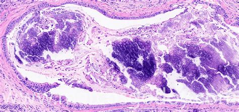 Nephrocalcinosis In Atlantic Salmon Salmon Salar Histop Flickr