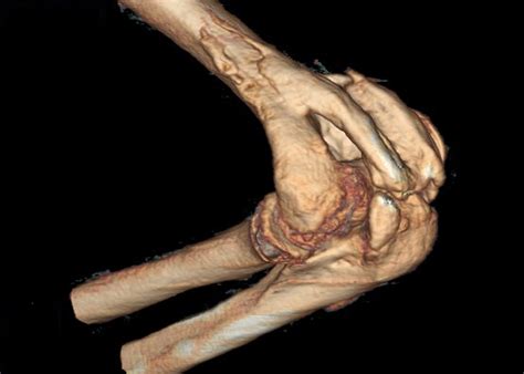 When Bone Grows Beyond The Elbow Skeleton Heterotopic Ossification
