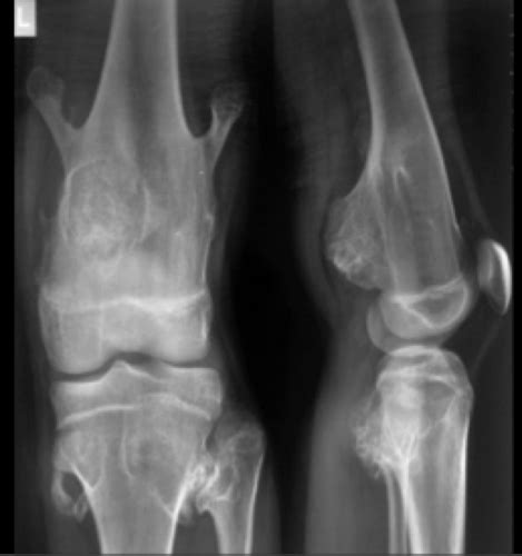 15 Benign Tumors Of Msk Flashcards Quizlet