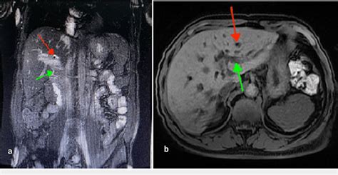A 70 Years Old Patient With Cholangitis Mri With Coronal T2 A And