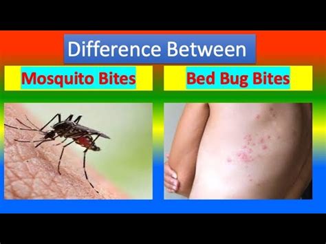 Mosquito Bite Vs Bed Bug Bite